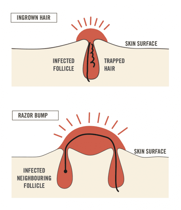 UNDERSTANDING RAZOR BUMPS – WHAT CAUSES IT AND HOW TO TREAT IT – DX Smooth